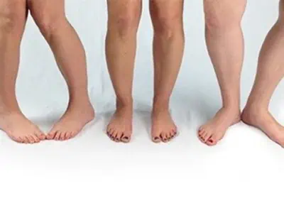 Common Kids Foot Problems - Columbia Asia Hospital I Private Hospital ...