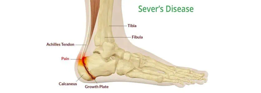 Common Kids Foot Problems - Columbia Asia Hospital I Private Hospital ...