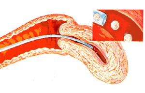 Six Steps of IVF from Conception to Completion - Columbia Asia Hospital ...