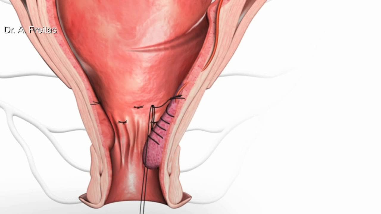 Elak Duduk Lama Dalam Tandas & Suka Meneran Jika Tak Mahu Alami Buasir, Pakar Ini Turut ...