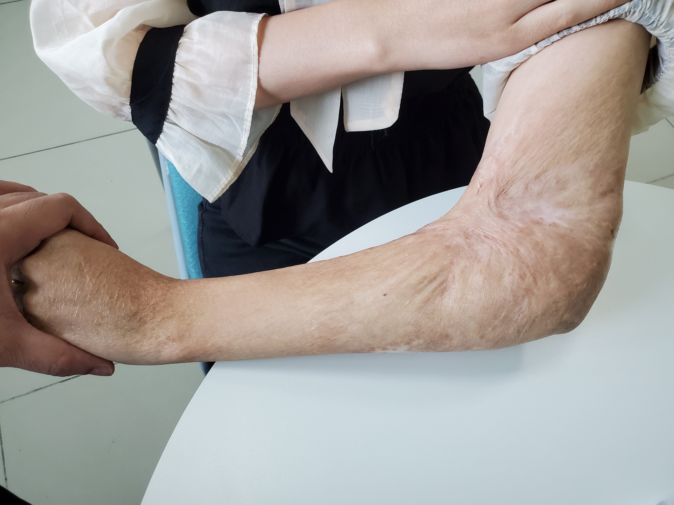 Giải phóng khớp khuỷu do sẹo bỏng co rút | Columbia Asia Hospital - Vietnam